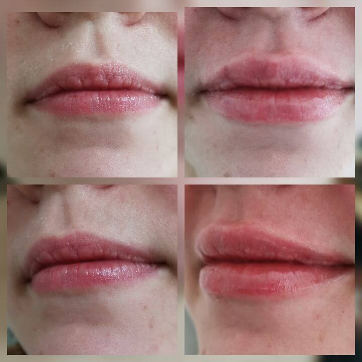 Dermal fillers – Sun Goddess Skin Aesthetics